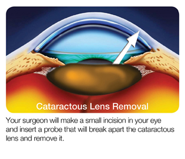 Cataracts